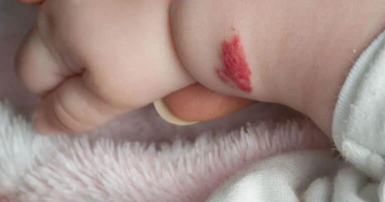 Baby Stork Bites & Birth Marks: Tips for Newborn Skin Care Treatment ...